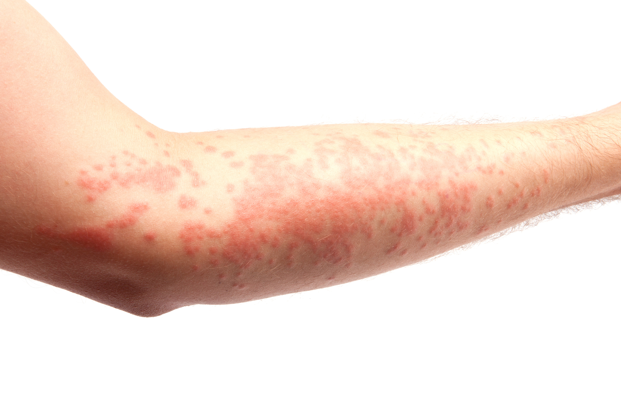 Skin Rashes Alpine Allergy Asthma Associates Inc